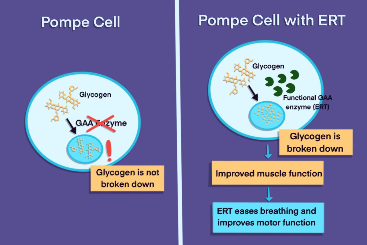Pompe disease treatment: What are the options? | Pompe Disease News